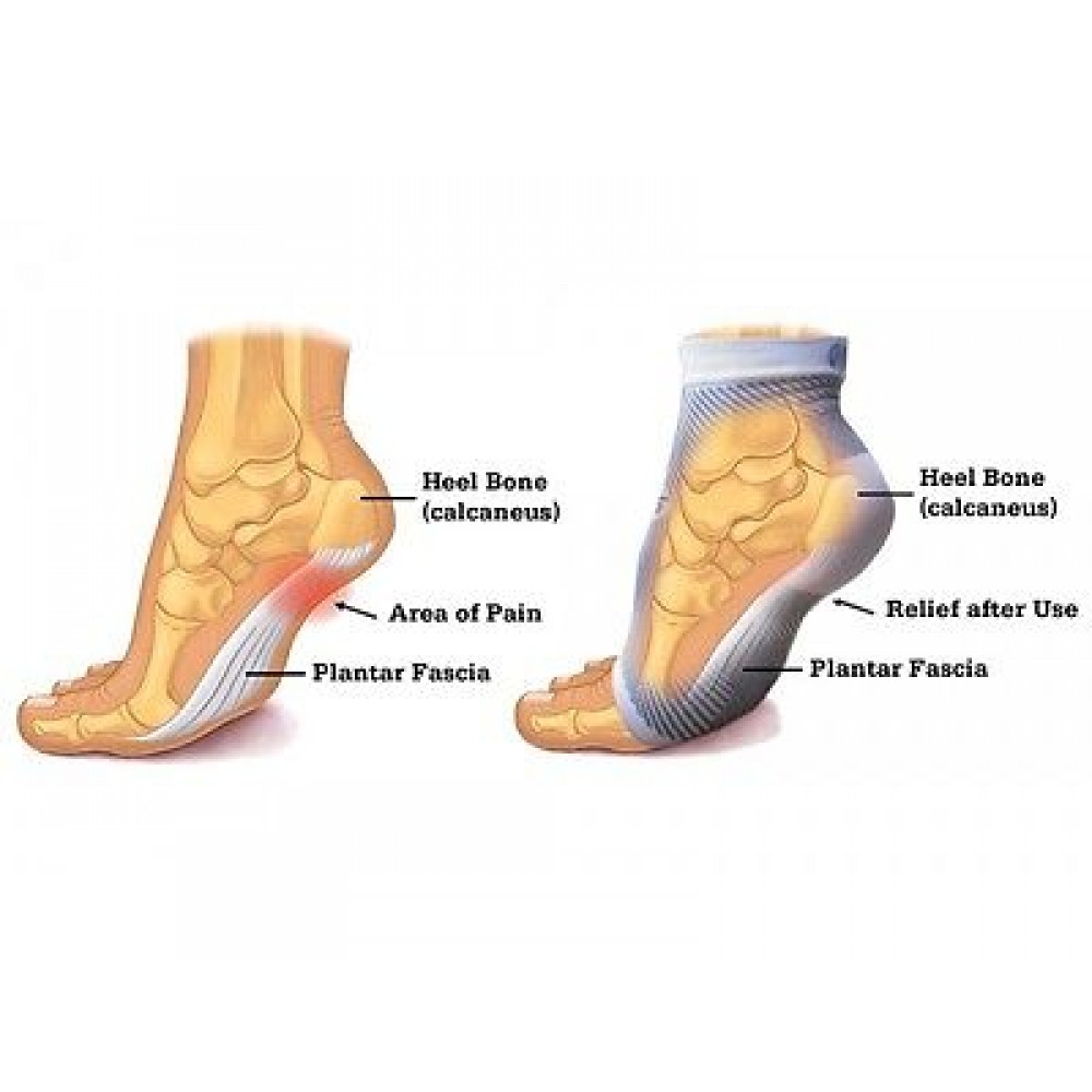 OS1st FS6 Compression Foot Sleeve Pairs - Socks for Heel Pain - Plantar ...